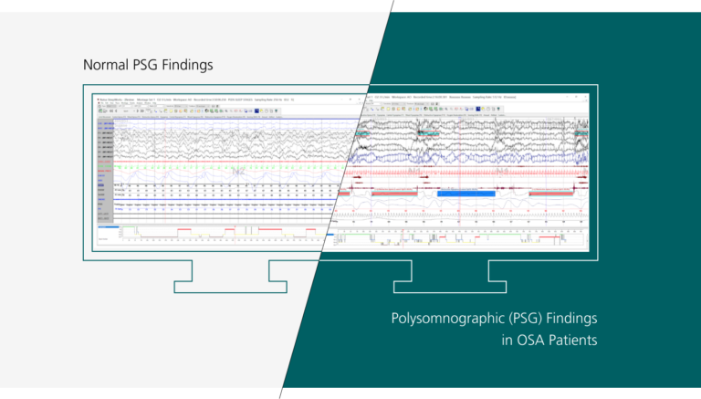 Sleep Apnea: Symptoms, Diagnosis, Treatment - Natus